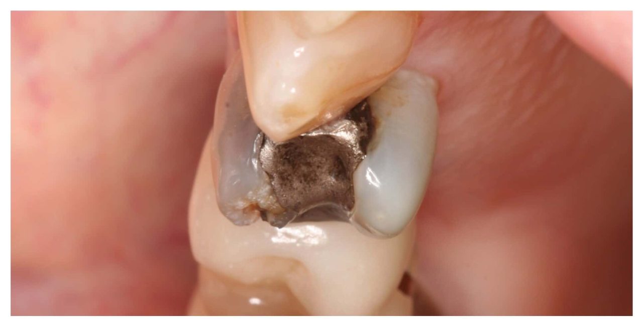 Before & After Smiles - Dr. Gerald Chan - Gaithersburg Dentist