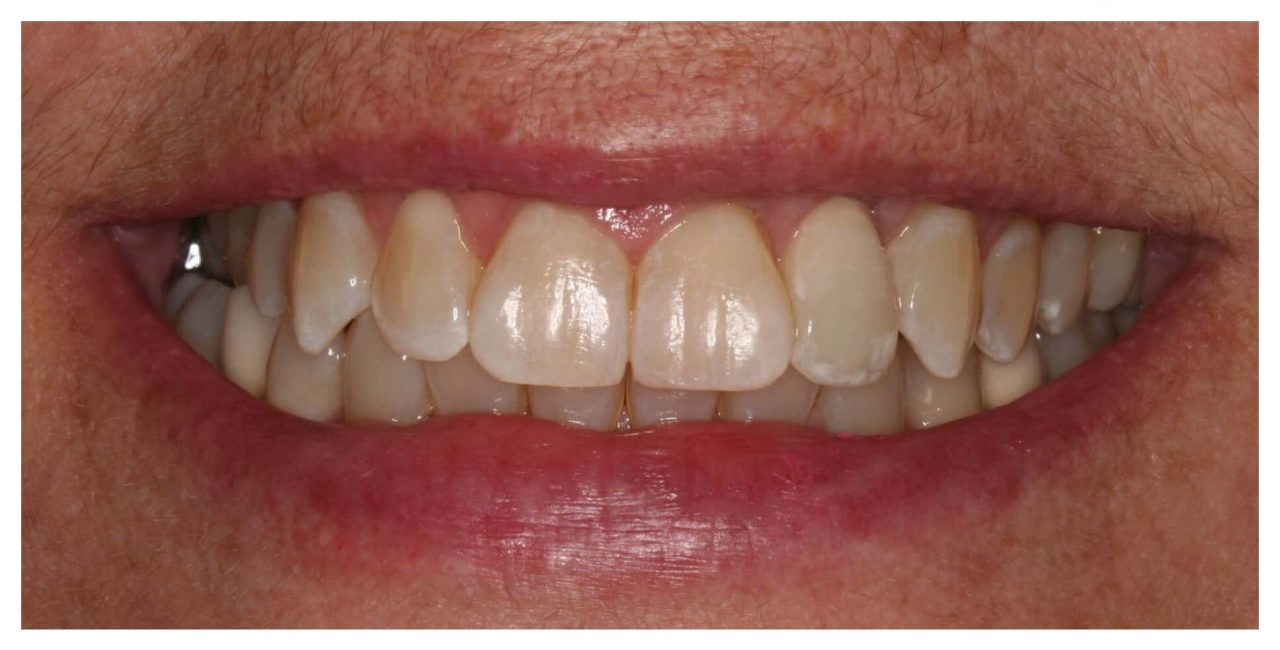Before & After Smiles - Dr. Gerald Chan - Gaithersburg Dentist