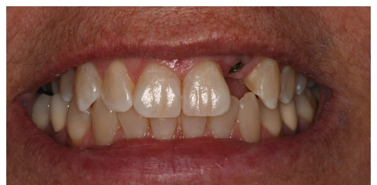 Before & After Smiles - Dr. Gerald Chan - Gaithersburg Dentist