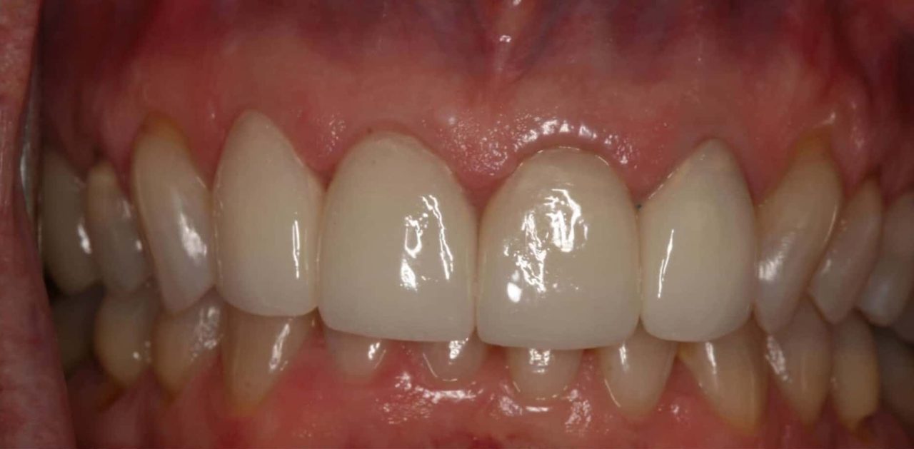 Before & After Smiles - Dr. Gerald Chan - Gaithersburg Dentist